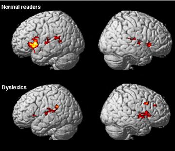 The Origin of Dyslexia | Blue Moose Literacy